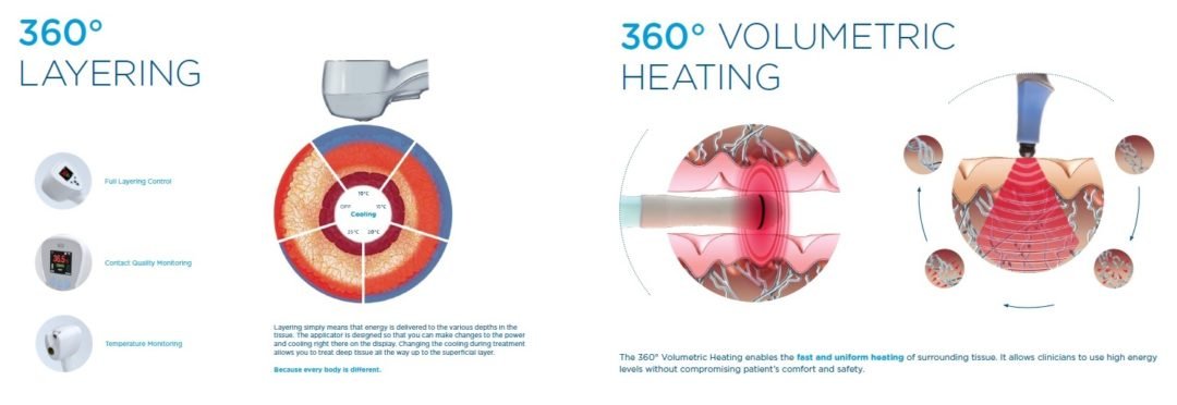 Body Contouring with Exilis Ultra 360 | BeautySmart Spa